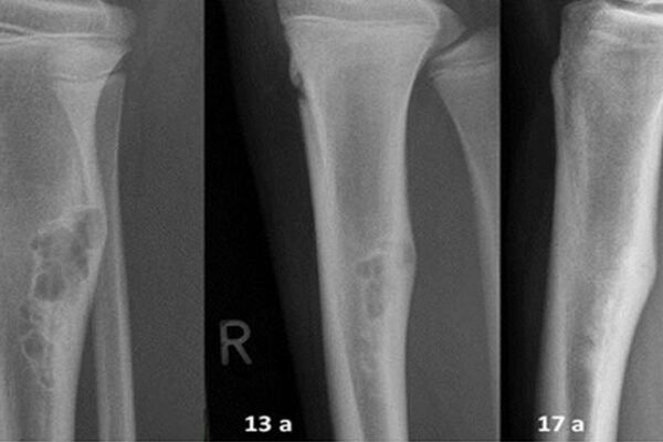 Soft Tissue Sarcoma – Way To Heal