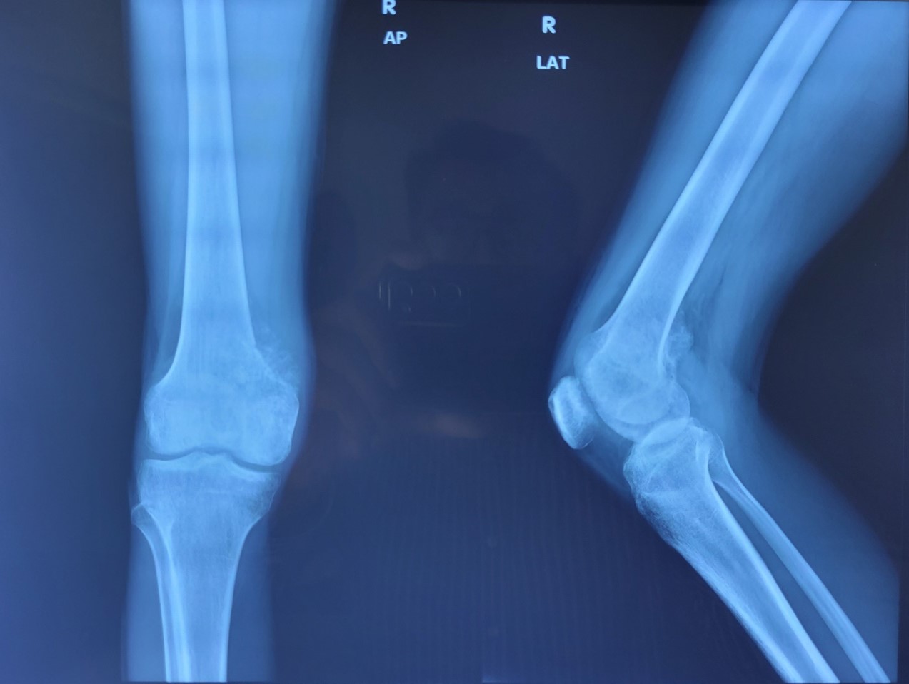 Case of Osteosarcoma of THIGH BONE – Way To Heal